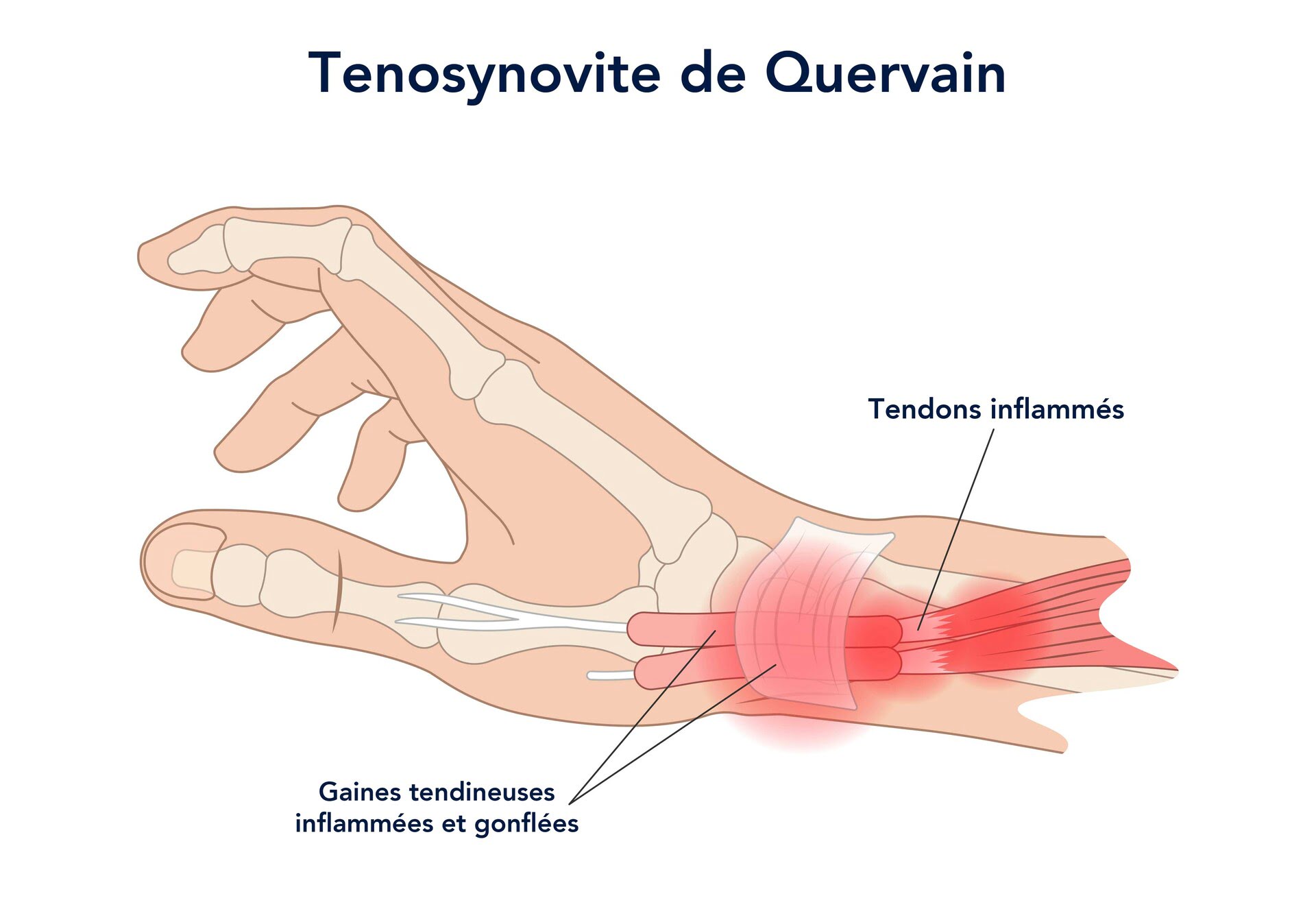 Tendinite du poignet : causes, traitements et rôle des attelles ...